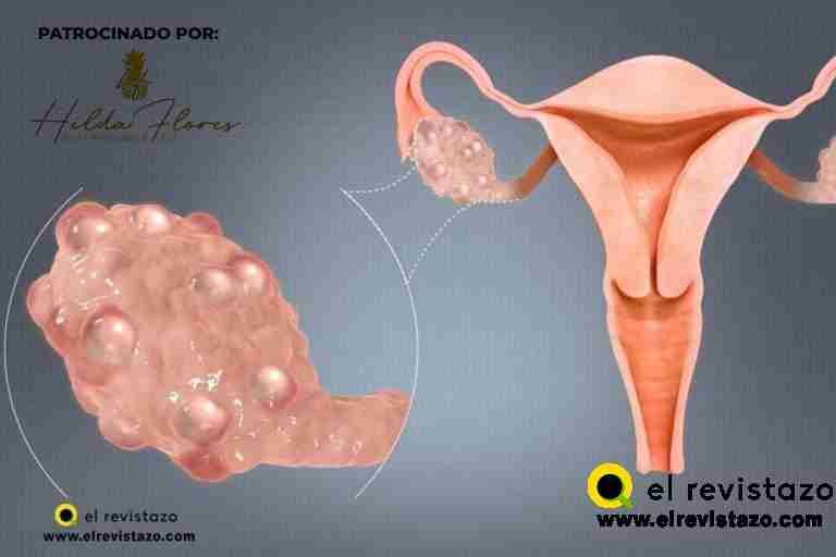 Síndrome De Ovario Poliquístico Entendiendo Una Condición Femenina 8464